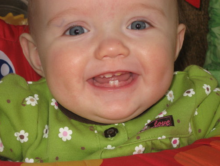 The Teeth of a Newborn Baby – Baby Care - Toddlers Need